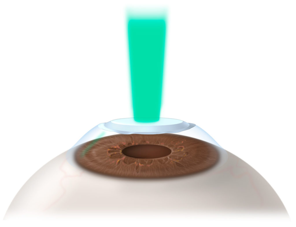 El Láser Excimer y la PRK cumplen 30 años - FacoElche.com