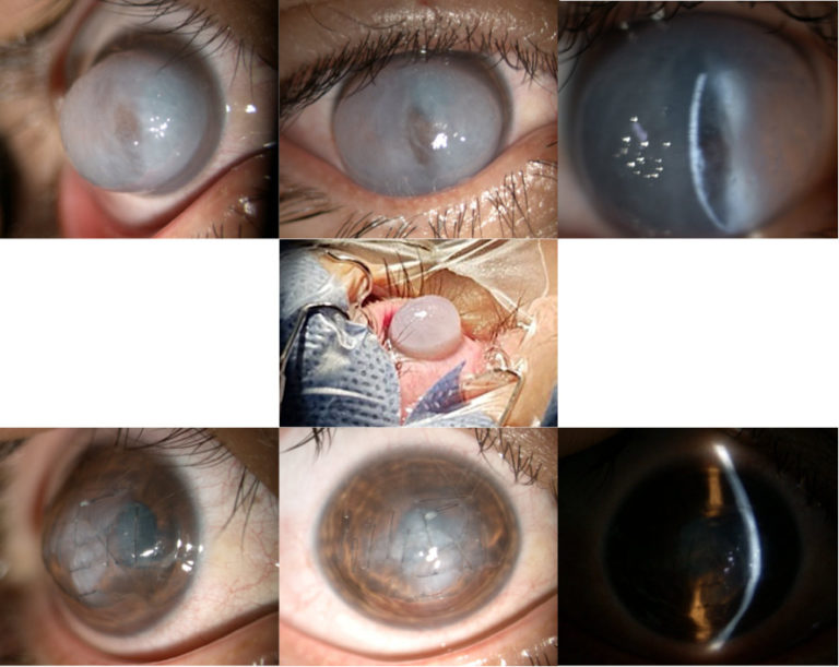 Hidrops corneal - FacoElche.com