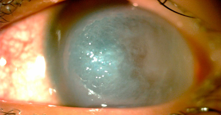 Hidrops corneal - FacoElche.com