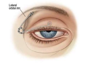 El lagoftalmos y su manejo - FacoElche.com