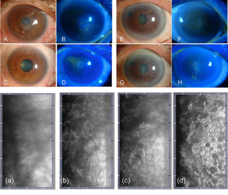 La distrofia endotelial de Fuchs y la queratopatía bullosa ...