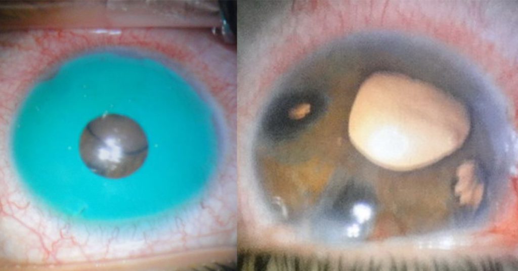 Síndrome de fluido en la interfase y New Color Iris Implant - FacoElche.com