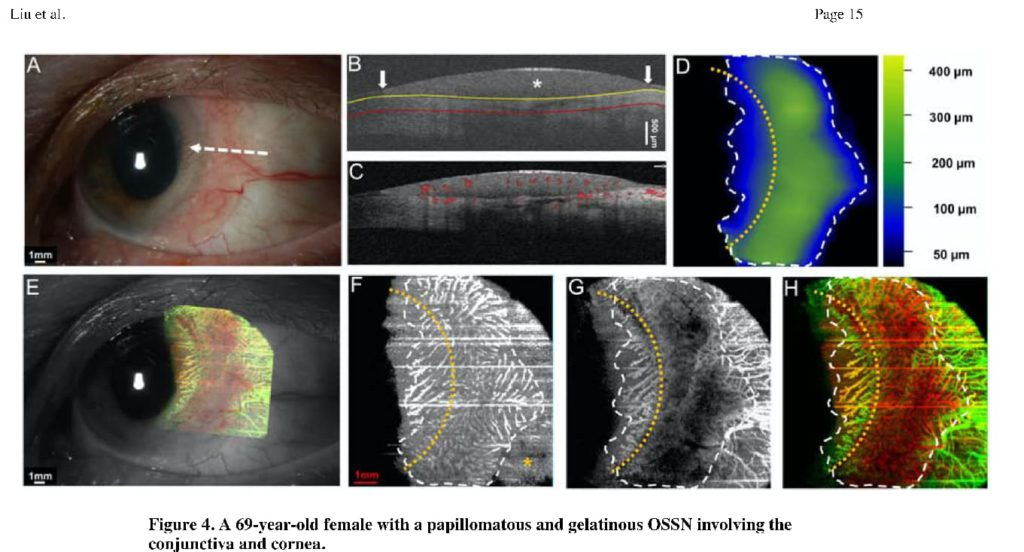 Actualización en Neoplasia Escamosa de la Superficie Ocular (OSSN ...