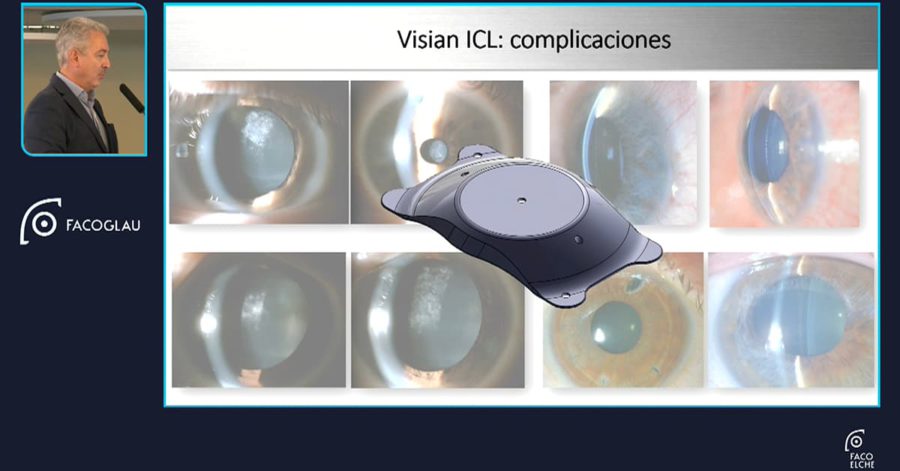 Tratamiento quirúrgico de una ectasia - Crosslinking - FacoElche.com