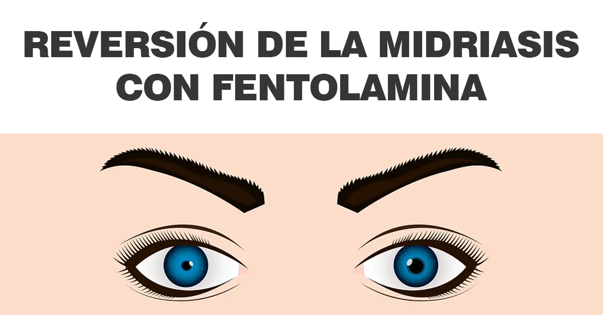 Reversión de la midriasis con Fentolamina - FacoElche.com